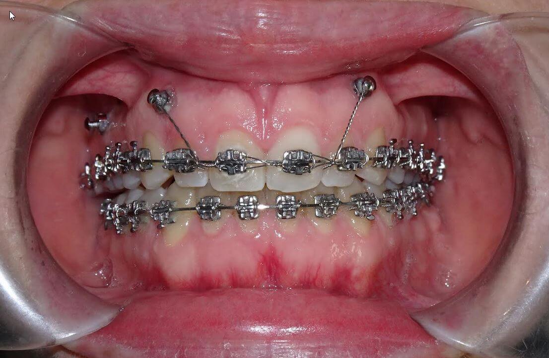 ¿Qué son los microtornillos en ortodoncia? | ceobaza.es